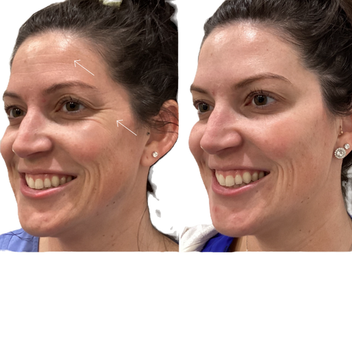 Expert Botox Treatments in Phoenixville, PA | Nakd Aesthetics