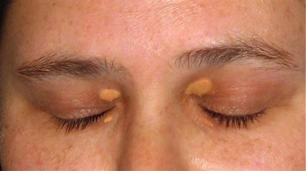 Cautery Procedure: The Essential Solution for Removing Skin Concerns ...