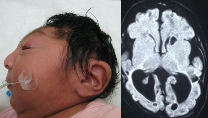 #142 Citomegalovirus congénito: nuevas recomendaciones para prevención ...