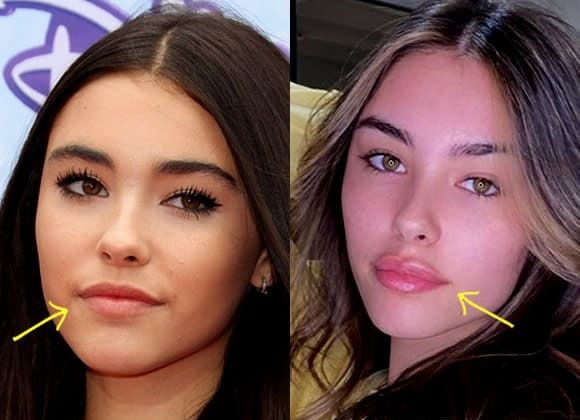 Did Madison Beer Have Plastic Surgery?