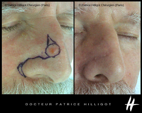 Traitement des carcinomes | SOS Tumeur Peau | France