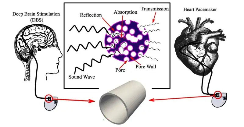 Rethinking the brain pacemaker: How better nanocomposites can improve ...