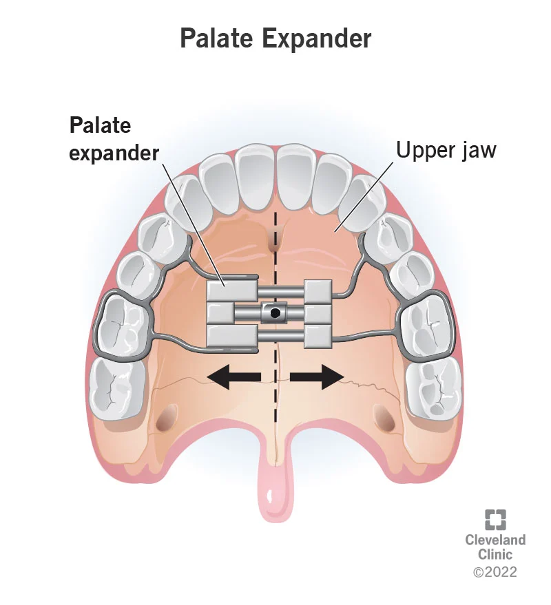 Palatal Expander | Ortho On Main