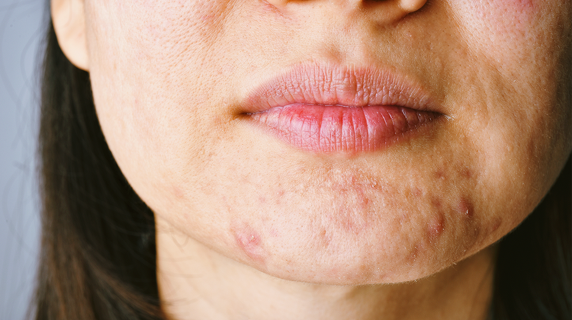 Late blooming - Acne Tarda