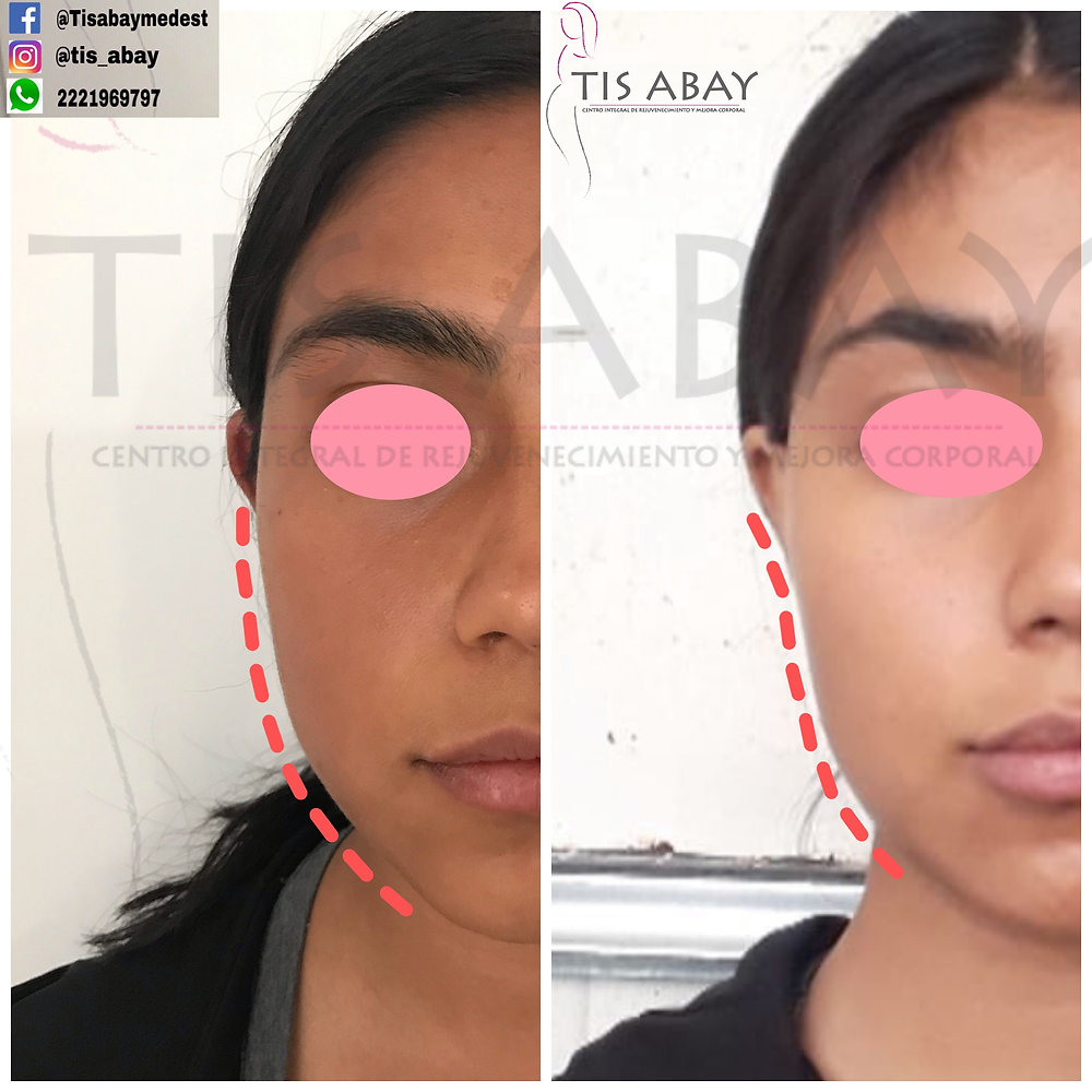 perfilamiento facial enzimatico vs bichectomia
