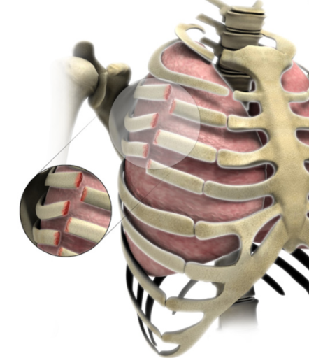 Rib Fracture - A Rare Complication of CPR Compressions