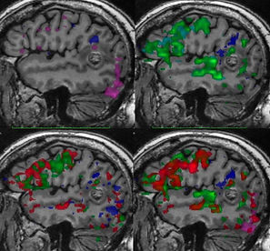 ASFNR | United States | The American Society of Functional Neuroradiology