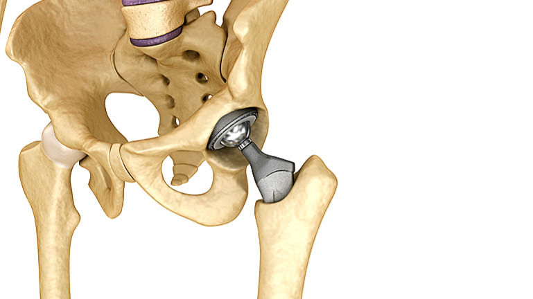 La Protesi d'Anca: un'efficace soluzione a gravi patologie articolari