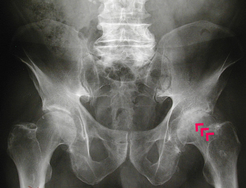 La Protesi d'Anca: un'efficace soluzione a gravi patologie articolari