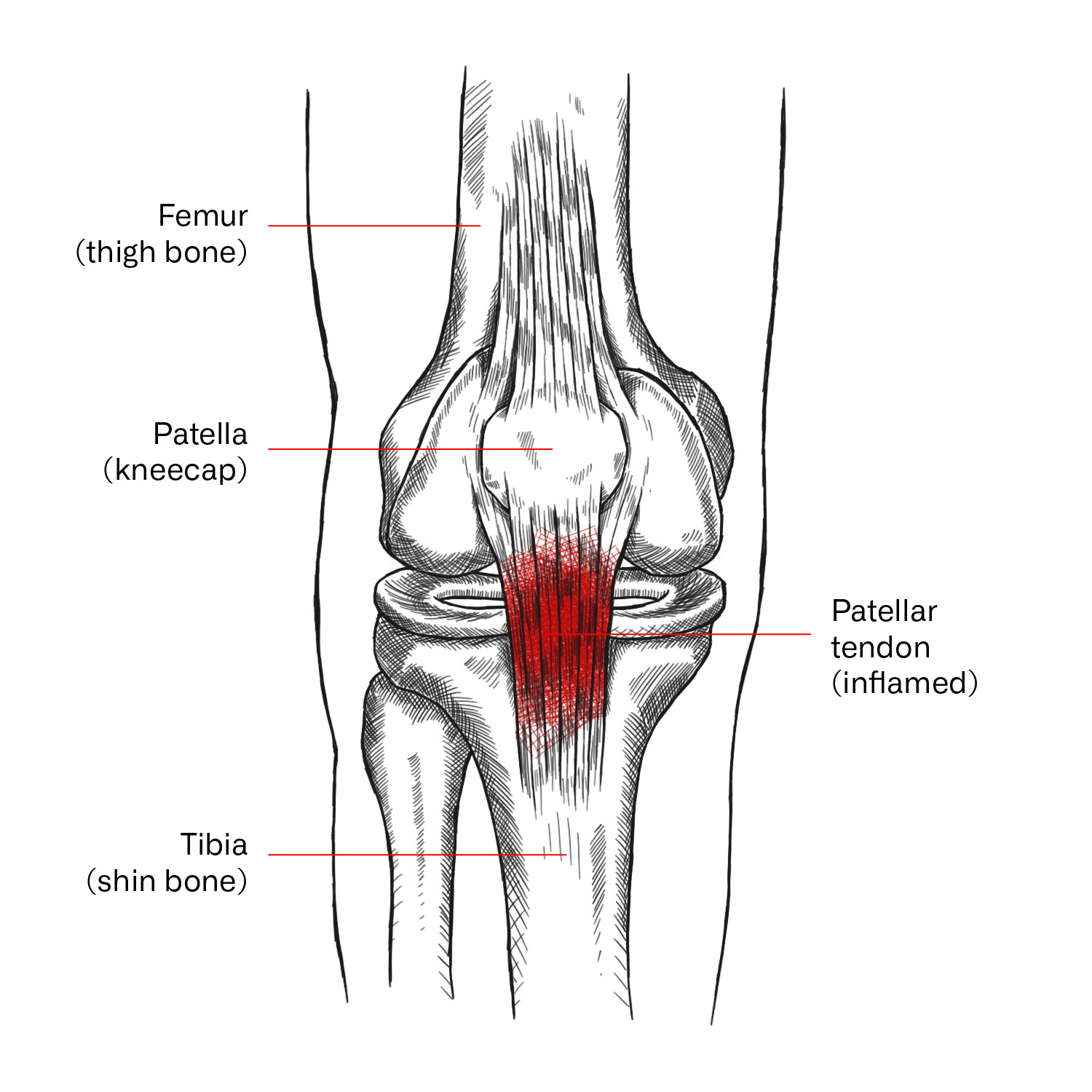 Patellar Tendonitis