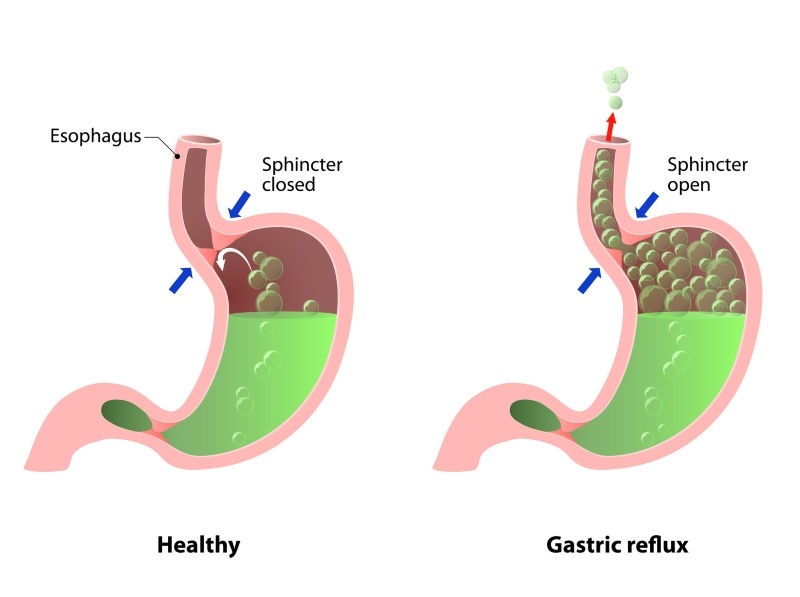 Why Stomach Acid is Good for you