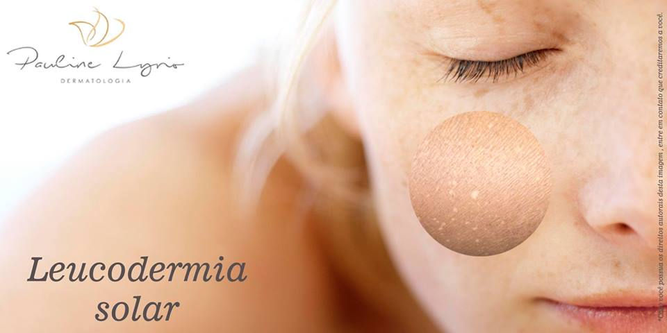 Leucodermia solar, sarda branca, marchas brancas