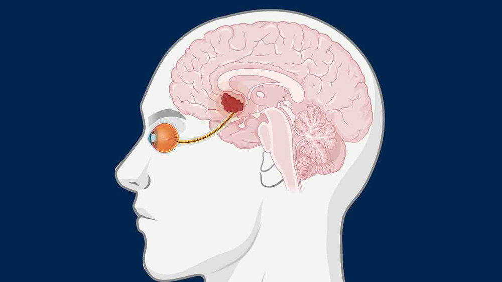 An overview of Optic nerve glioma