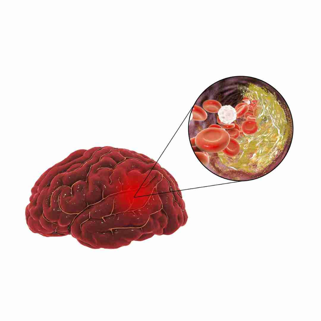 Vascular dementia