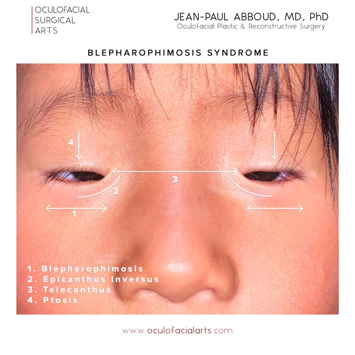 The Oculofacial Surgical Artist's Blog | Dr. Abboud | San Diego, CA