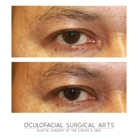 Eyelid & Orbital Lesions Gallery | San Diego, CA | Oculofacial Surgical ...