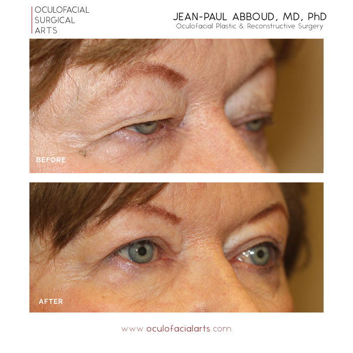 What causes the appearance of a droopy upper eyelid?