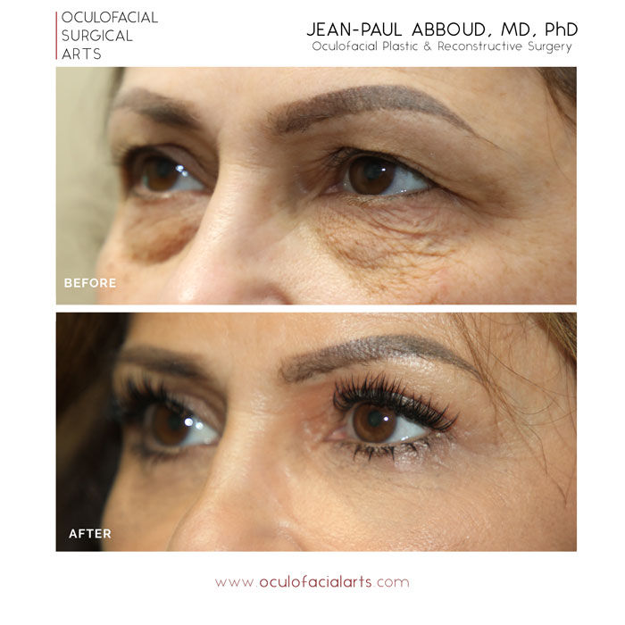 Wrinkles Around the Eyes: The Most Common Types and How to Treat Them