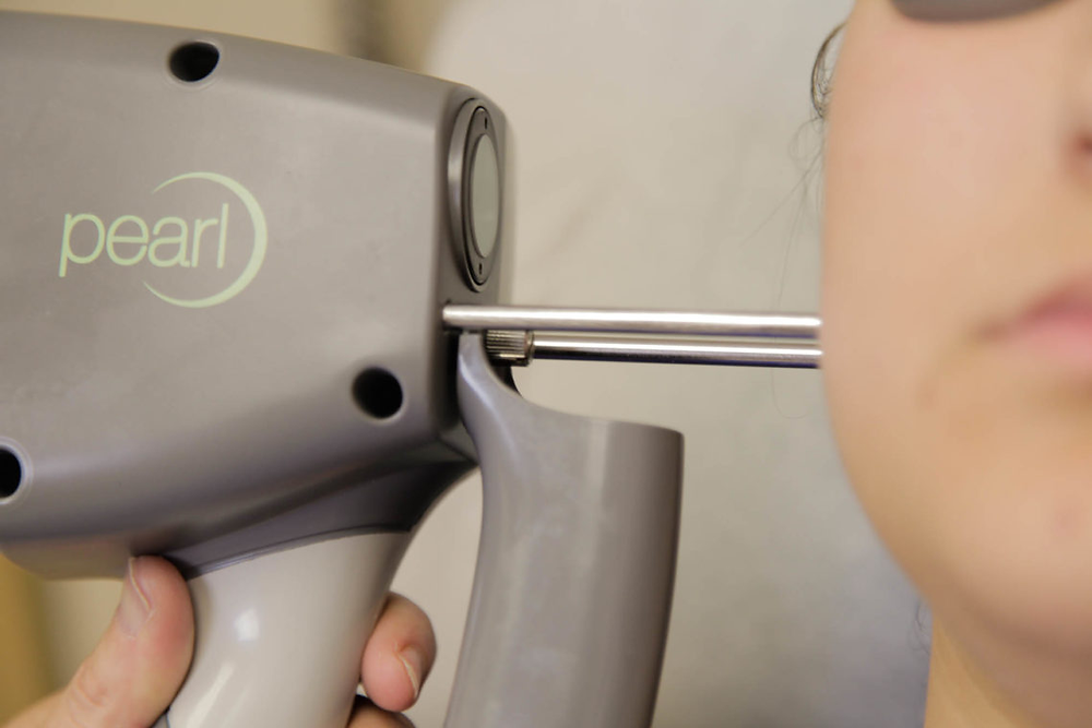 Cutera Pearl Laser Treatment: The Ultimate Skin Resurfacing Solution