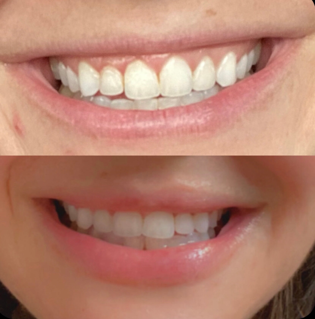 Botox Lip Flip Top & Bottom Lip | Envy Clinic & Spa