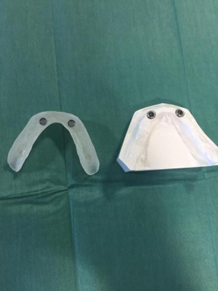 FDI – Implant Retained Dentures