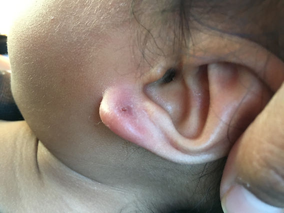 ear piercing infection complications
