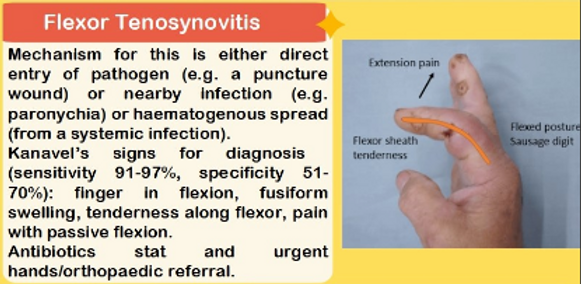 Flexor Tenosynovitis