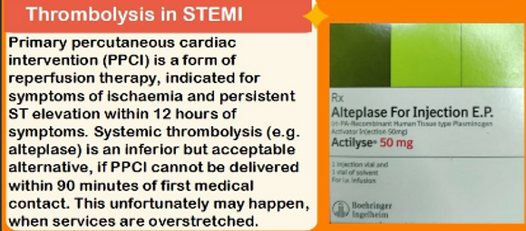 Thrombolysis in STEMI