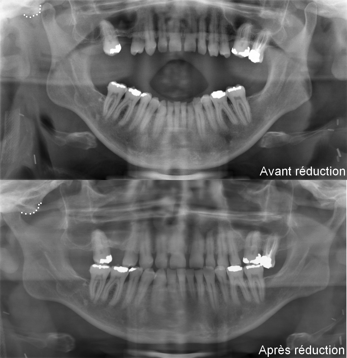 Luxation mandibulaire | maxilloclic