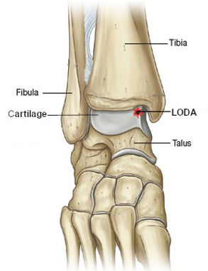 LODA - Lésion ostéochondrale | Dr Simon Tournemine