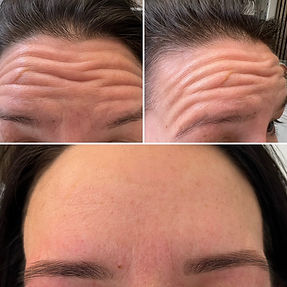Advanced Aesthetics - Botox | Dermal Fillers | Skin Boosters - Trowbridge