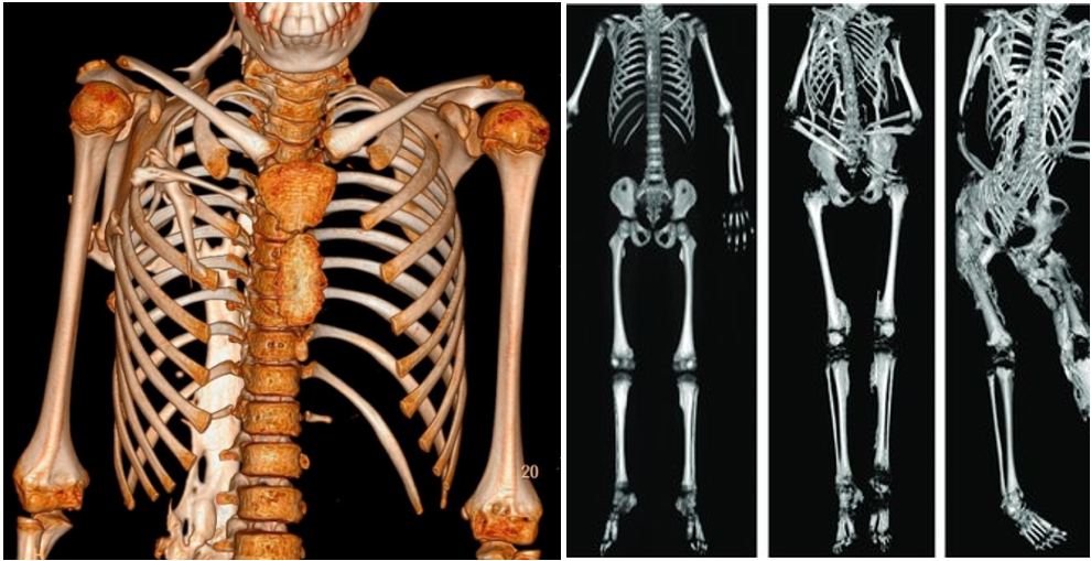 The Stoneman Syndrome