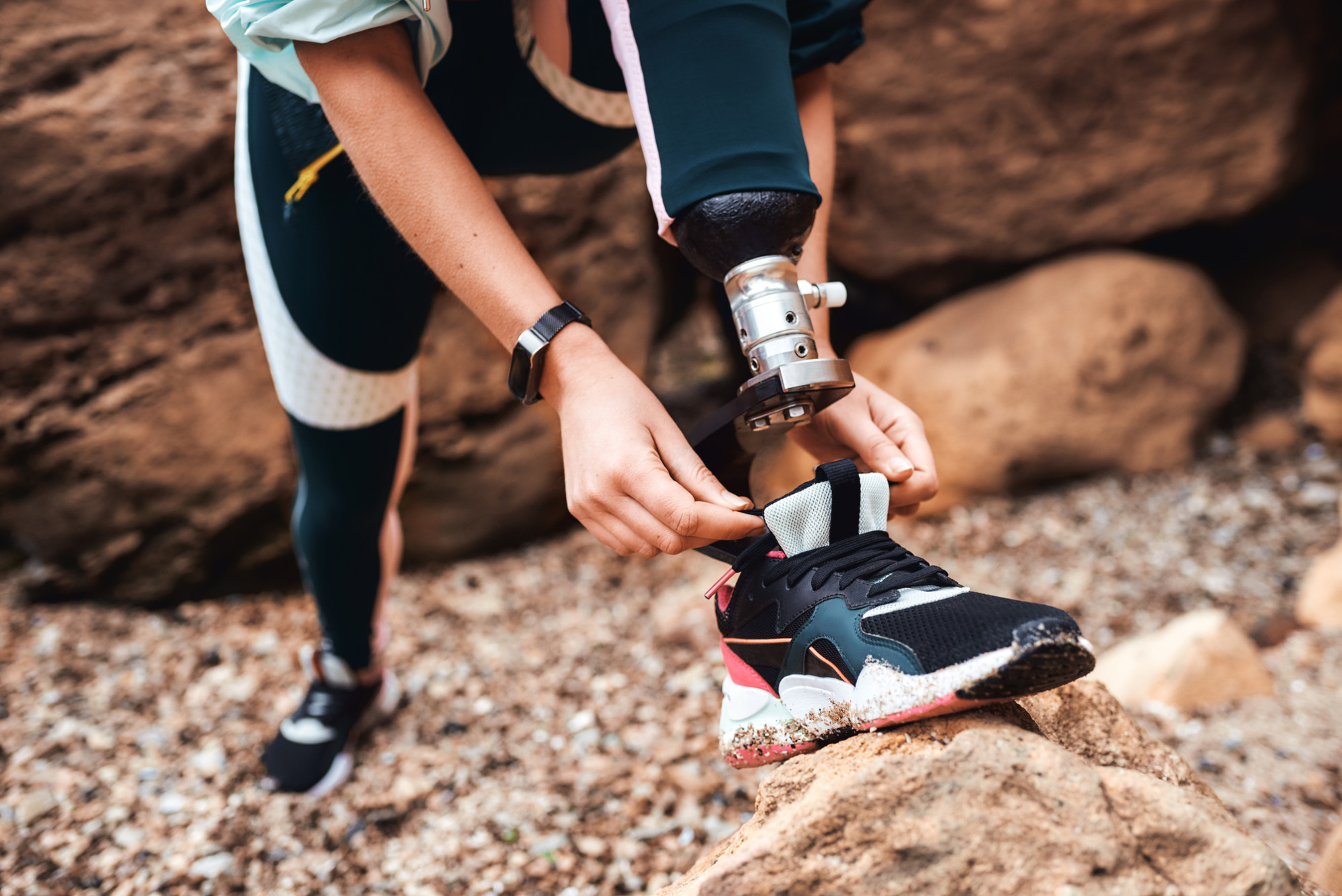 Prosthetic Arms London, ON | Forest City Prosthetics Inc.