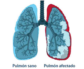 fibrosis pulmonar