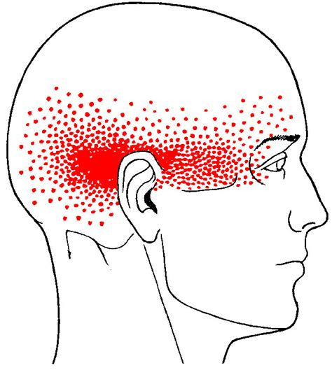 Sub occipital trigger point pain referral pattern symptoms and prevention.