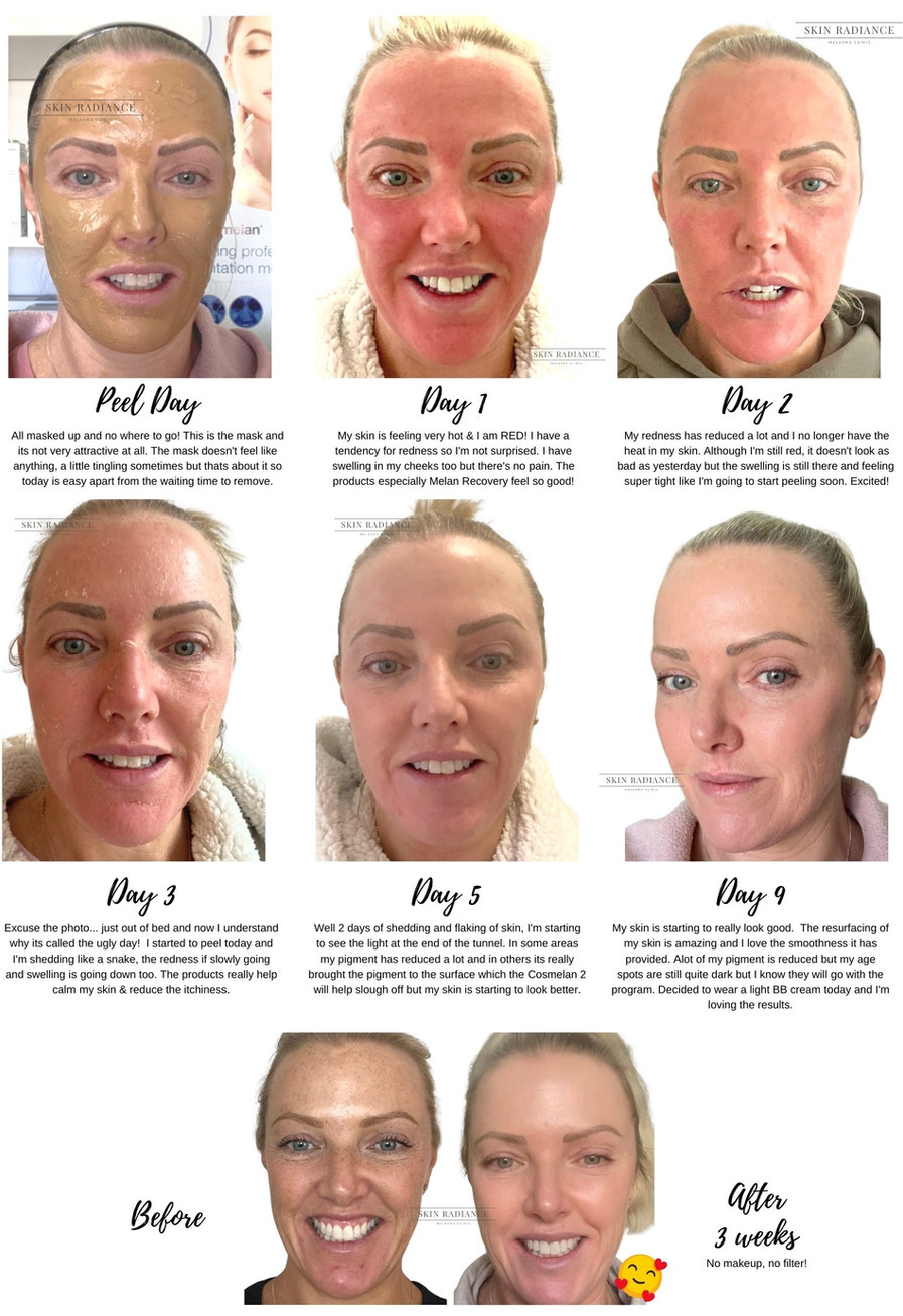 Cosmelan Diary | Skin Radiance Clinic | Cosmelan Peel Specialist ...