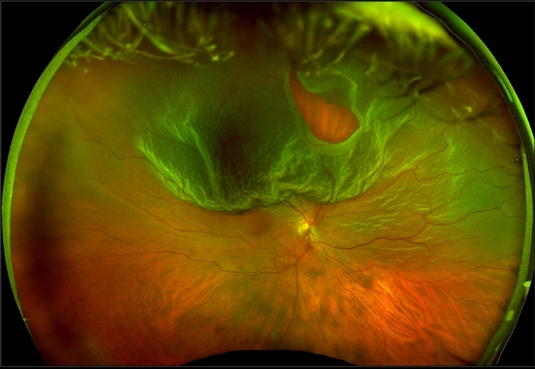 Retinal Detachment What You Need To Know About A Detached Retina retinal-detachment-what-you-need-to-know-about-a-detached-retina