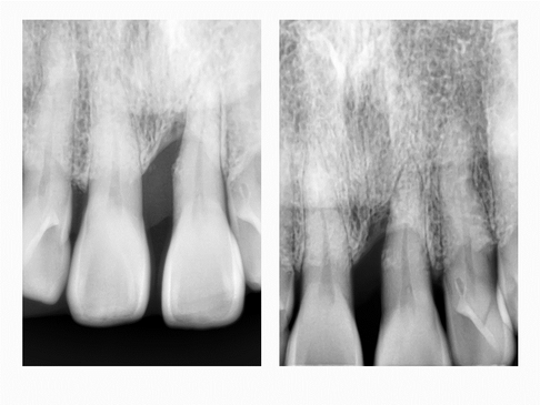 Periodontal Defect 1 | ti-oss