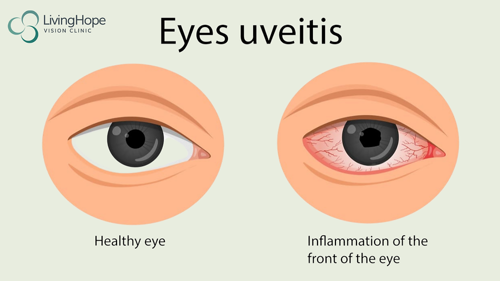 Understanding Inflammatory Eye Disease Uveitis: Causes, Symptoms and ...
