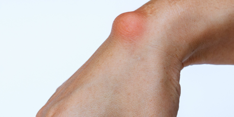 Hand lumps and bumps | Midland Hand Clinic