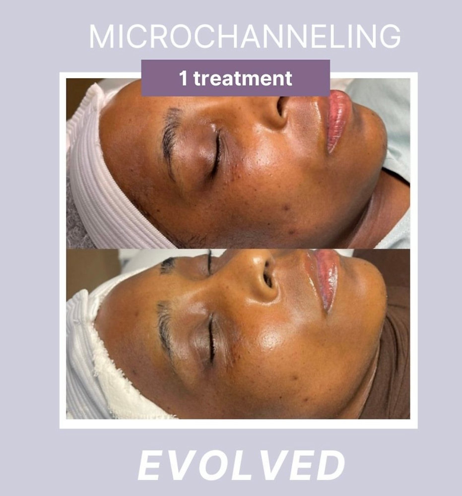 The Powerful Benefits of Microchanneling