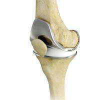 Minimally Invasive Knee Joint Replacement