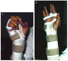 extensor tendon injury splint