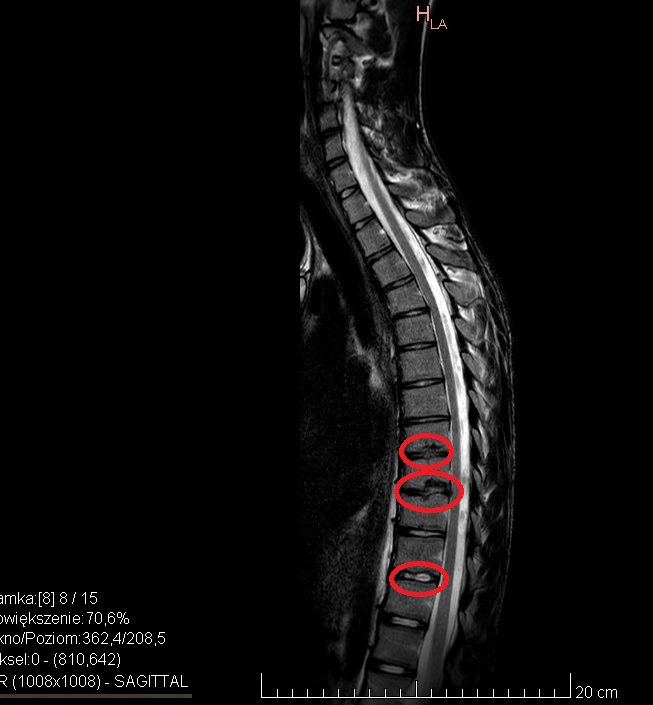 Choroba Scheuermanna czyli kifoza młodzieńcza. Objawy, przyczyny ...