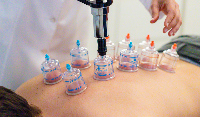 COMO A VENTOSA FUNCIONA? UMA TERAPIA CONTRA INFECÇÕES E INFLAMAÇÕES!