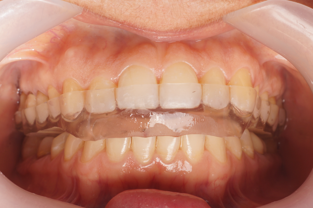 Wprowadzenie do okluzji FACE - wykorzystanie szyny MAGO w diagnostyce ...