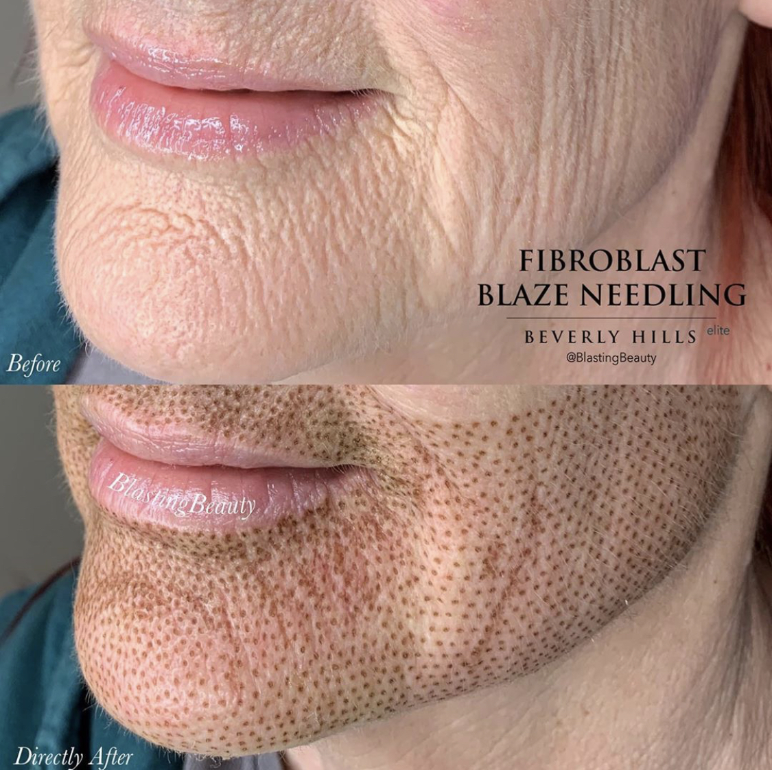 Fibroblast Skin Tightening | Bevely Hills