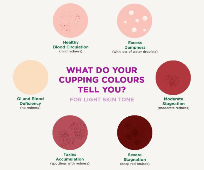 What do the Cupping Marks and Colors Mean?