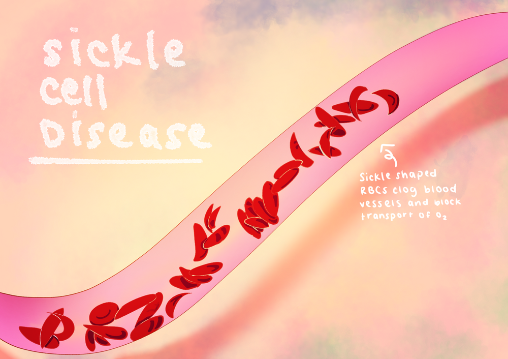 Understanding Sickle Cell Disorder
