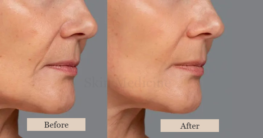 Botox on Jowls - A Comprehensive Guide to Risks and Benefits